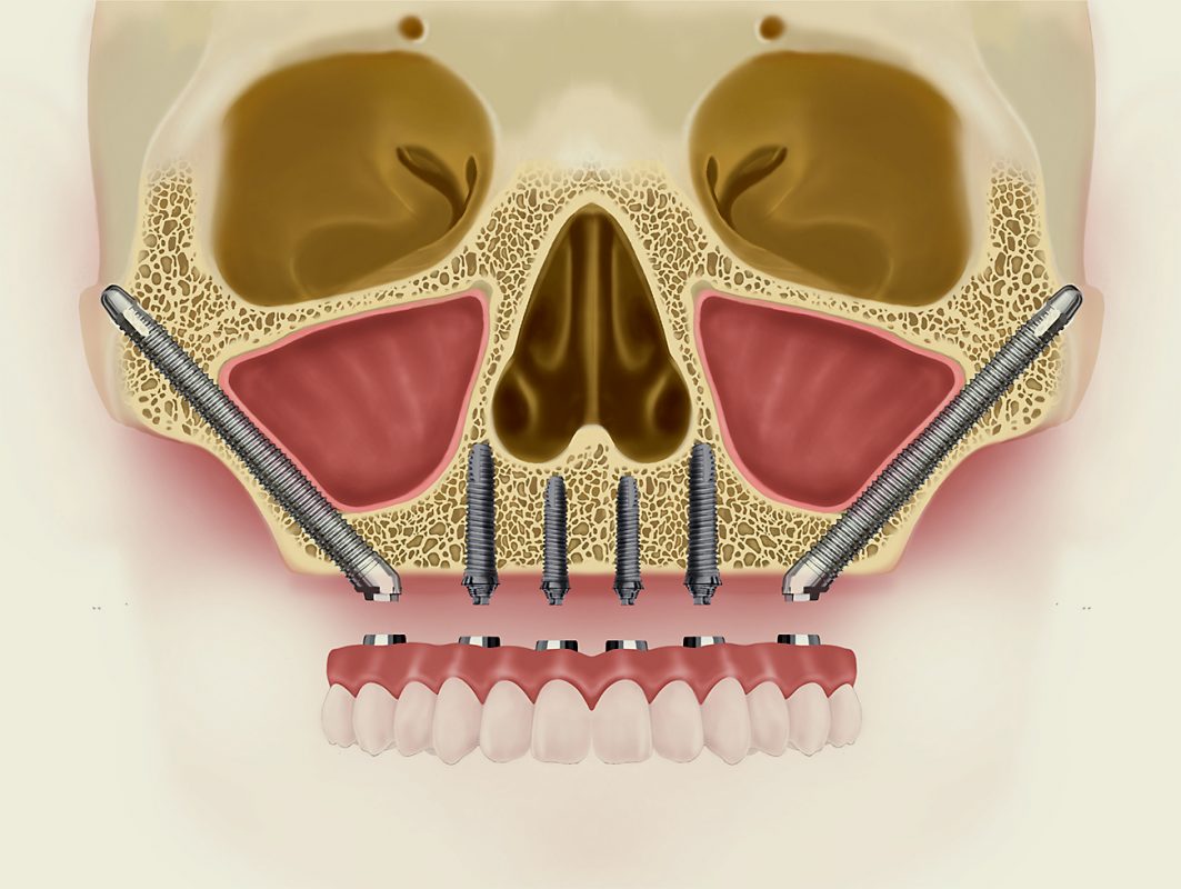 Zygomatic Implants - Nova DiŞ Beylikdüzü Ağız ve Diş Sağlığı Merkezi