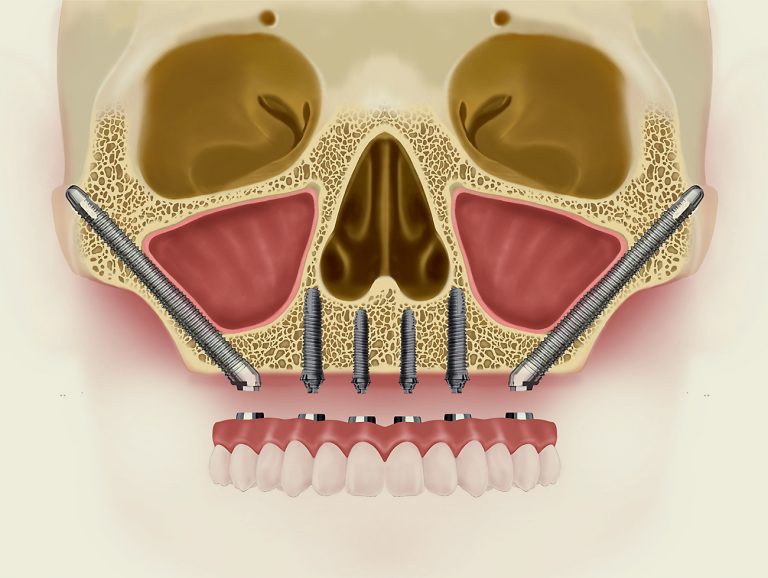 Zygomatic Implants - Nova DiŞ Beylikdüzü Ağız ve Diş Sağlığı Merkezi