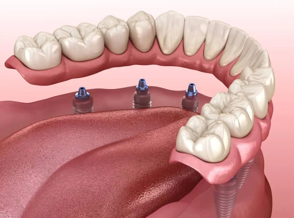 Full Arch Dental Implants - Nova DiŞ